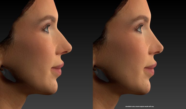 Best 3-D Vectra Imaging for Rhinoplasty Miami, FL | Dr. Marcelo Ghersi